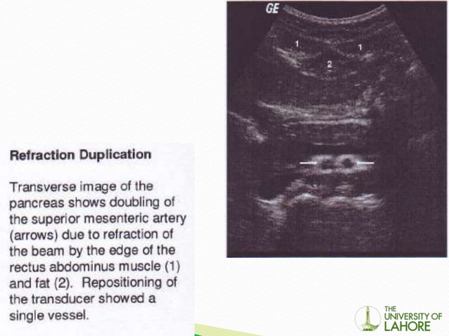 Artifacts in Ultrasound.pptx( by Jalil Hanafi) | PPTX | Digital Audio | Computer Software and ...