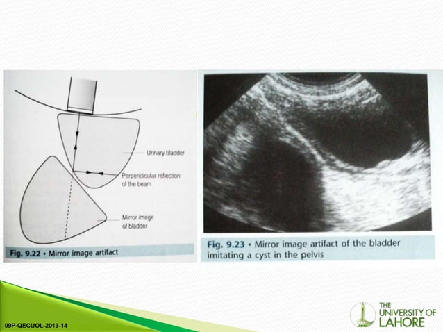 Artifacts in Ultrasound.pptx( by Jalil Hanafi) | PPTX | Digital Audio | Computer Software and ...