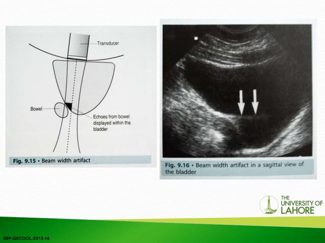 Artifacts in Ultrasound.pptx( by Jalil Hanafi) | PPTX | Digital Audio | Computer Software and ...