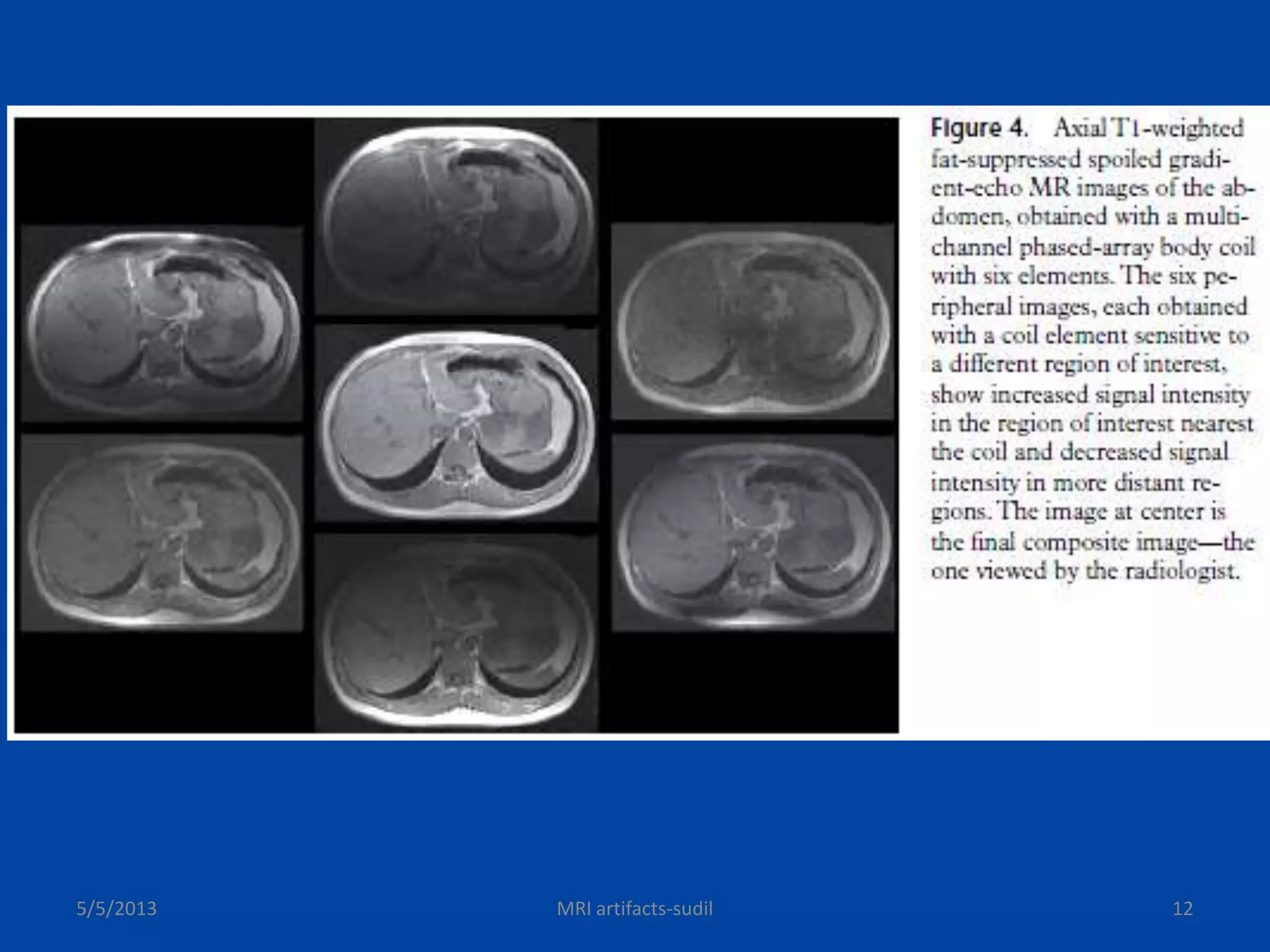MRI artifacts | PPTX