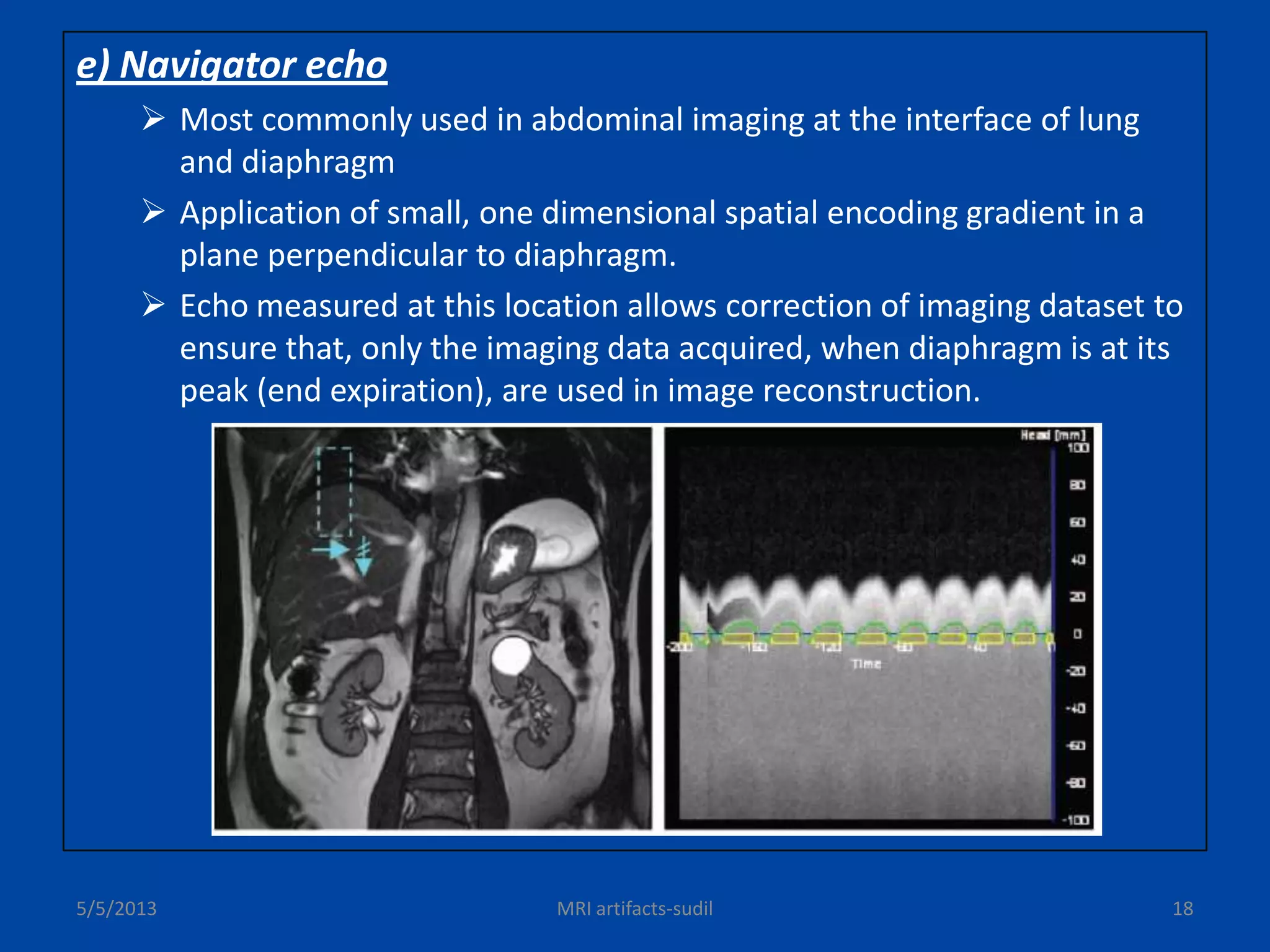 MRI artifacts | PPTX