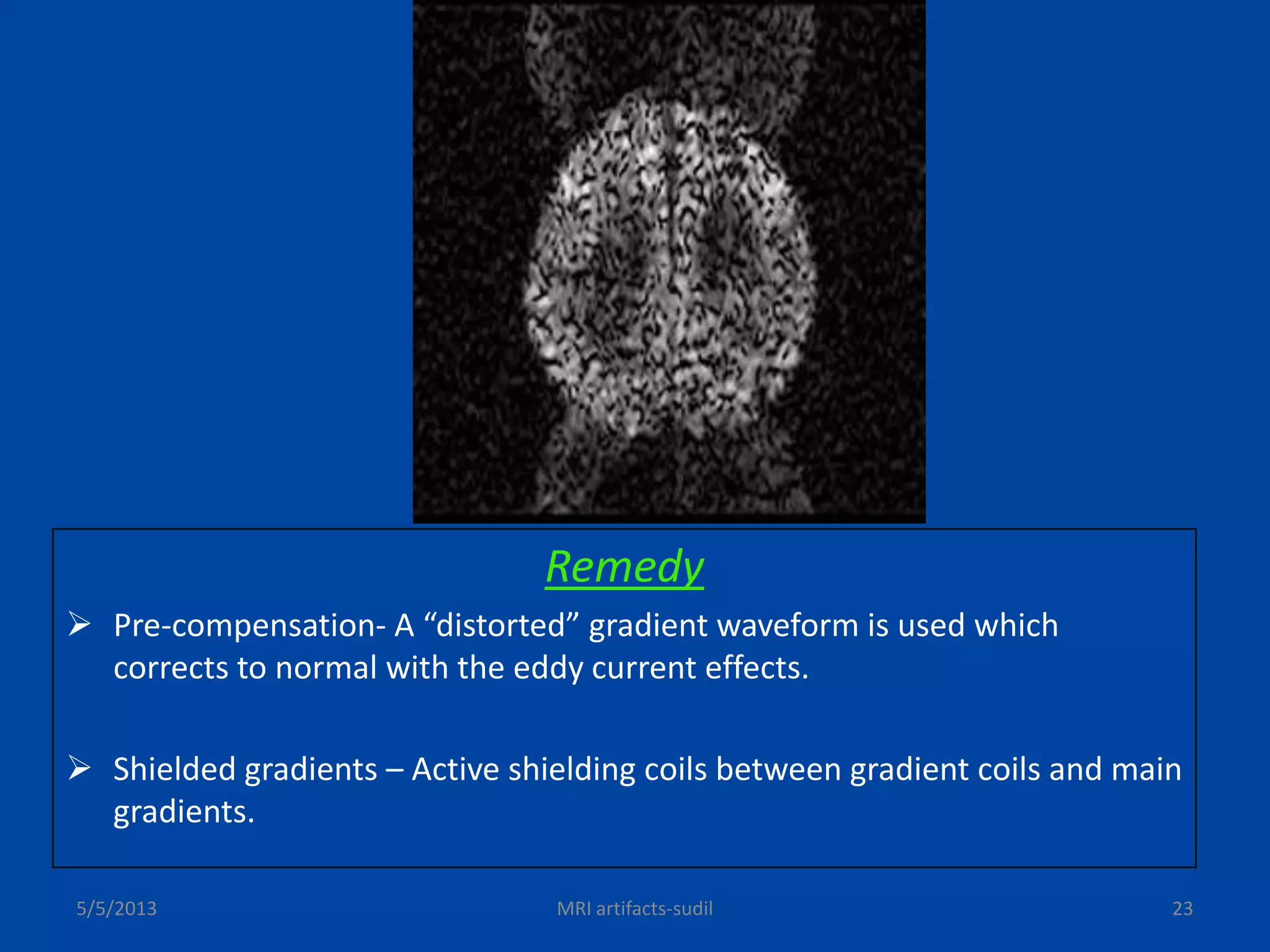 MRI artifacts | PPTX