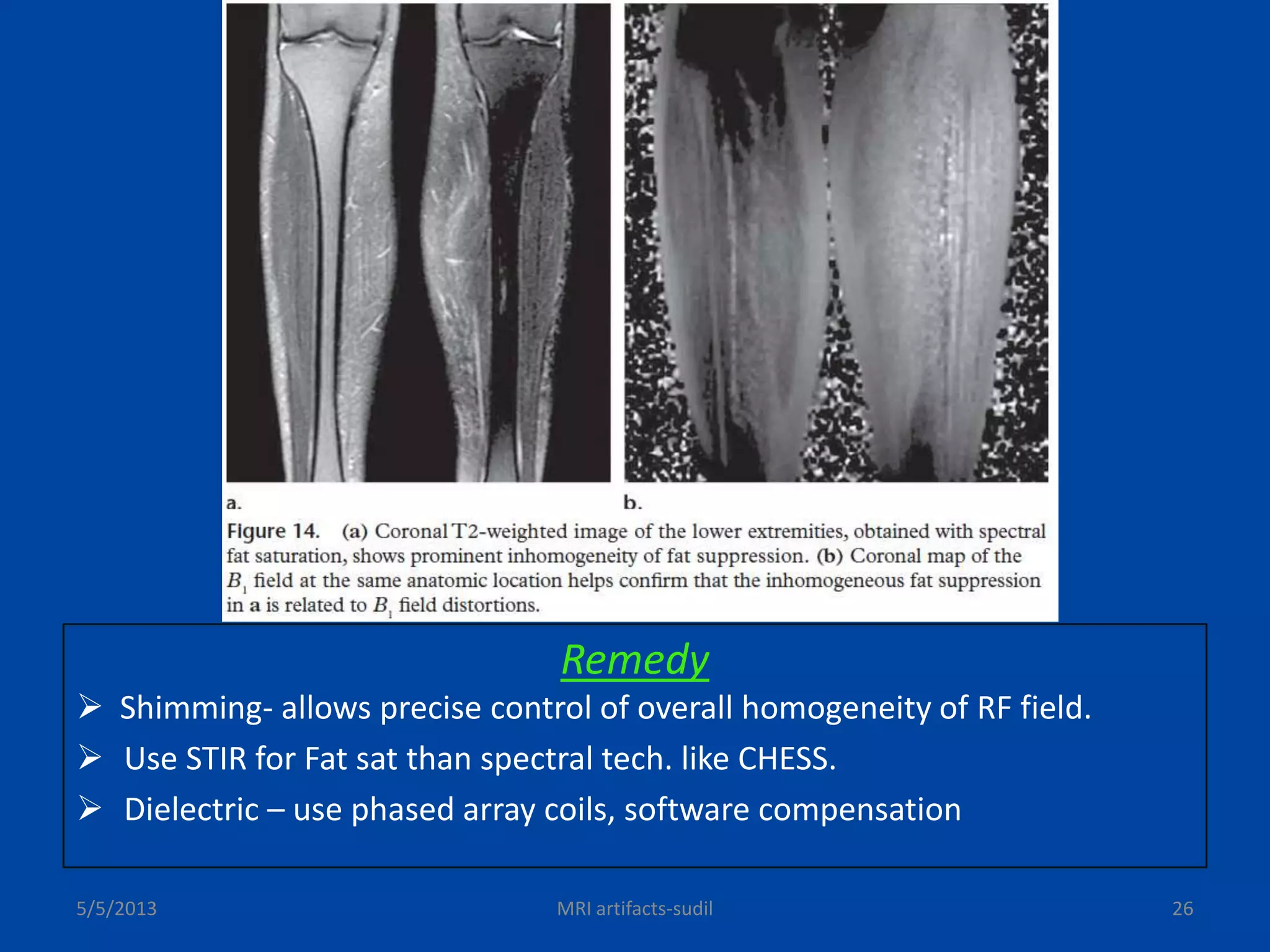 MRI artifacts | PPTX