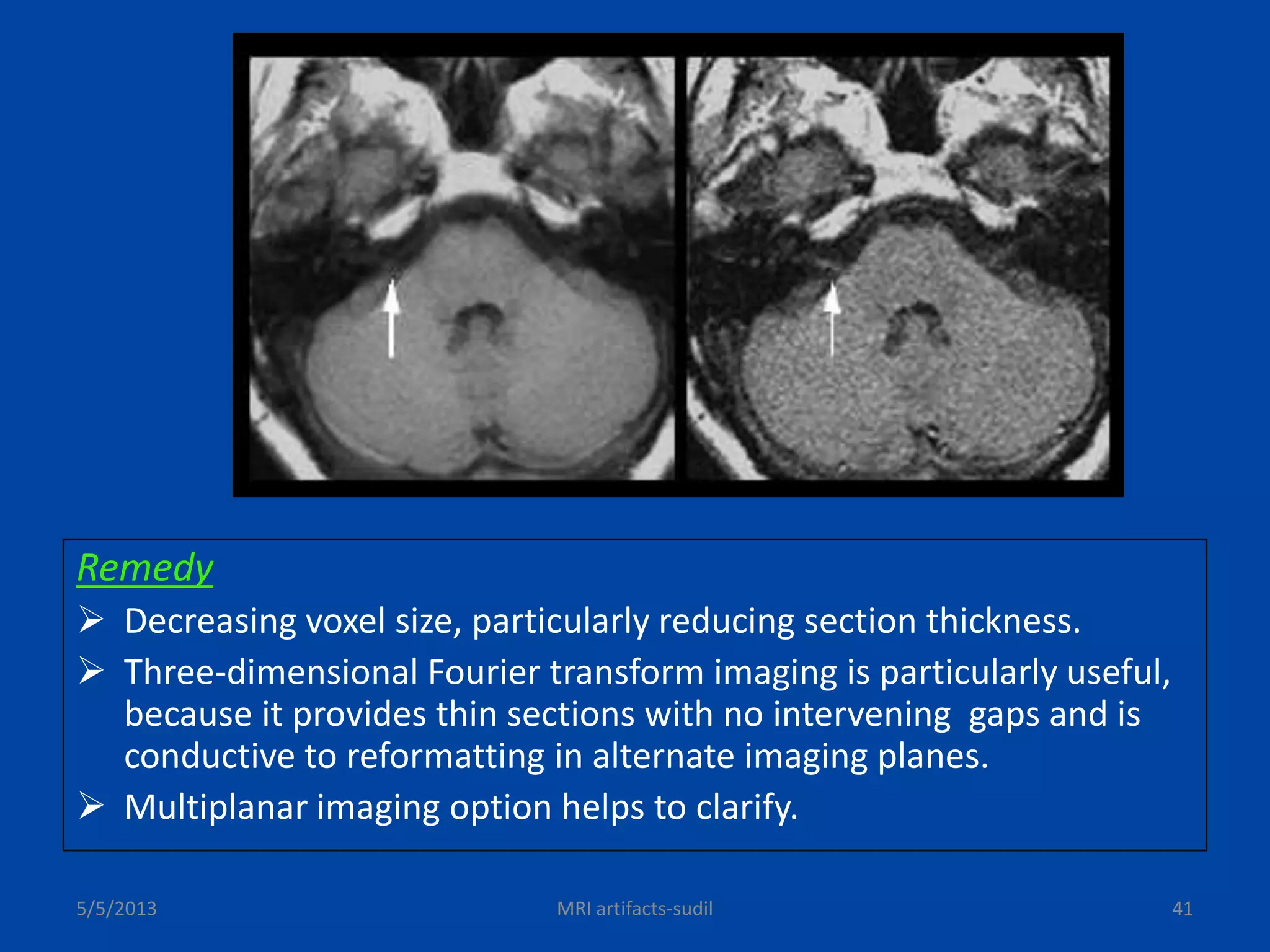 MRI artifacts | PPTX
