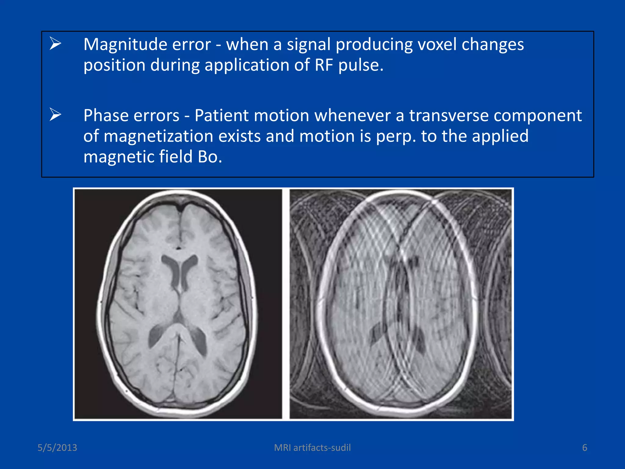 MRI artifacts | PPTX