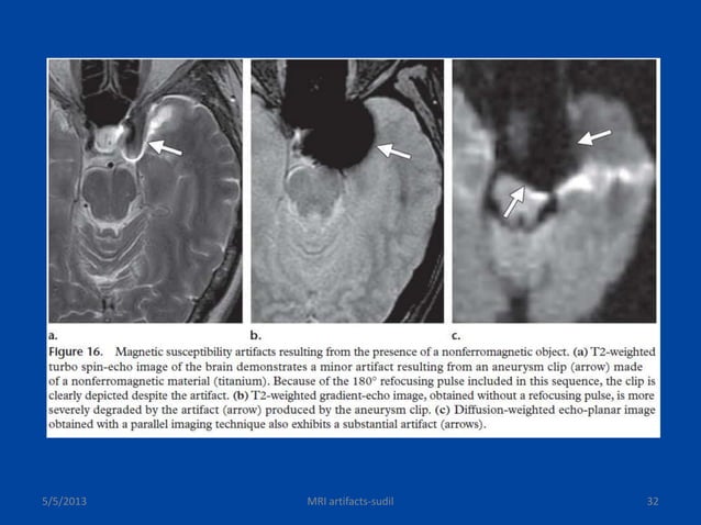 MRI artifacts | PPTX