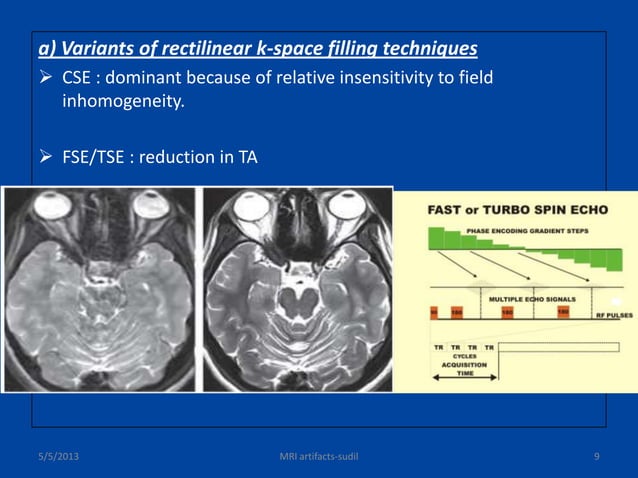 Mri Artifacts