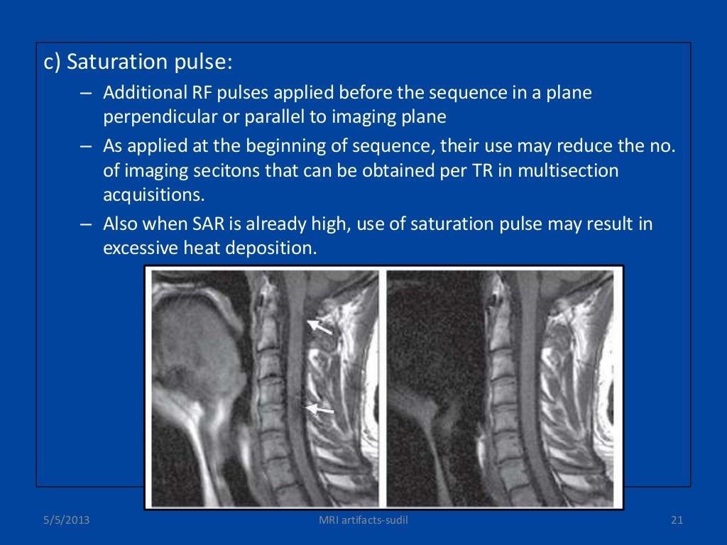 MRI artifacts