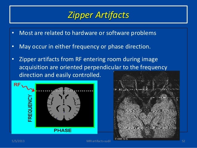 MRI artifacts