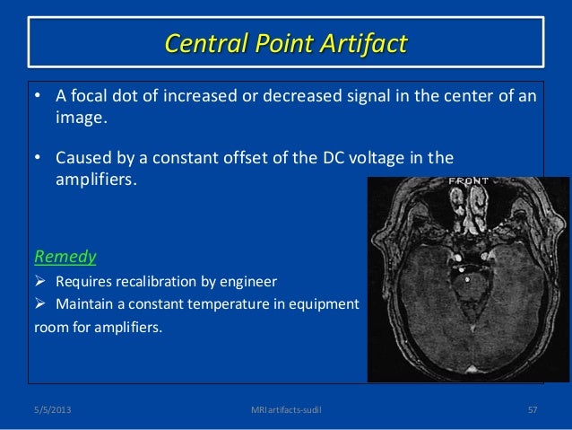 MRI artifacts