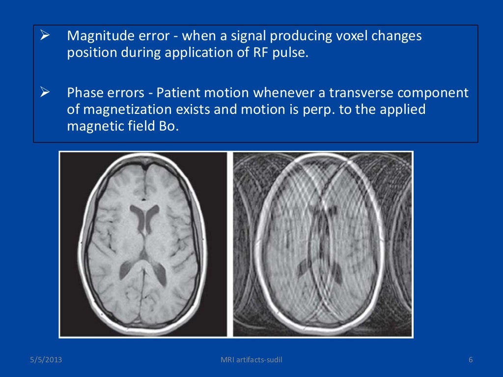 MRI artifacts