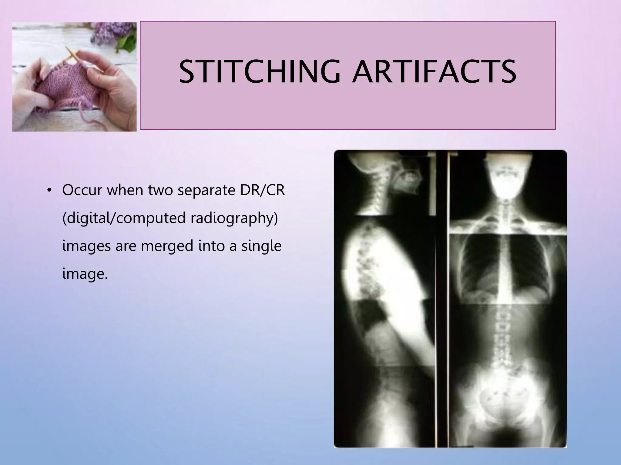 Artifacts in conventional radiology.pptx