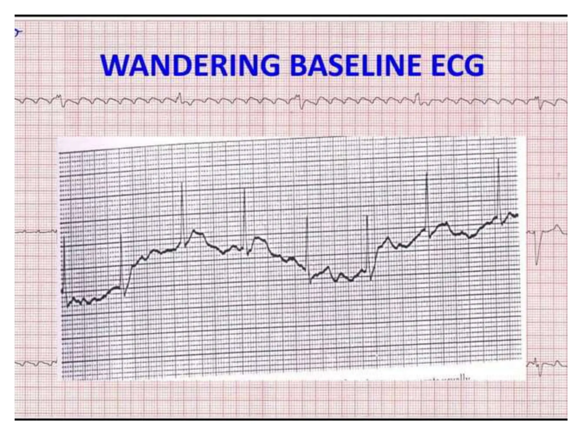 ARTIFACTS IN ECG.pptx