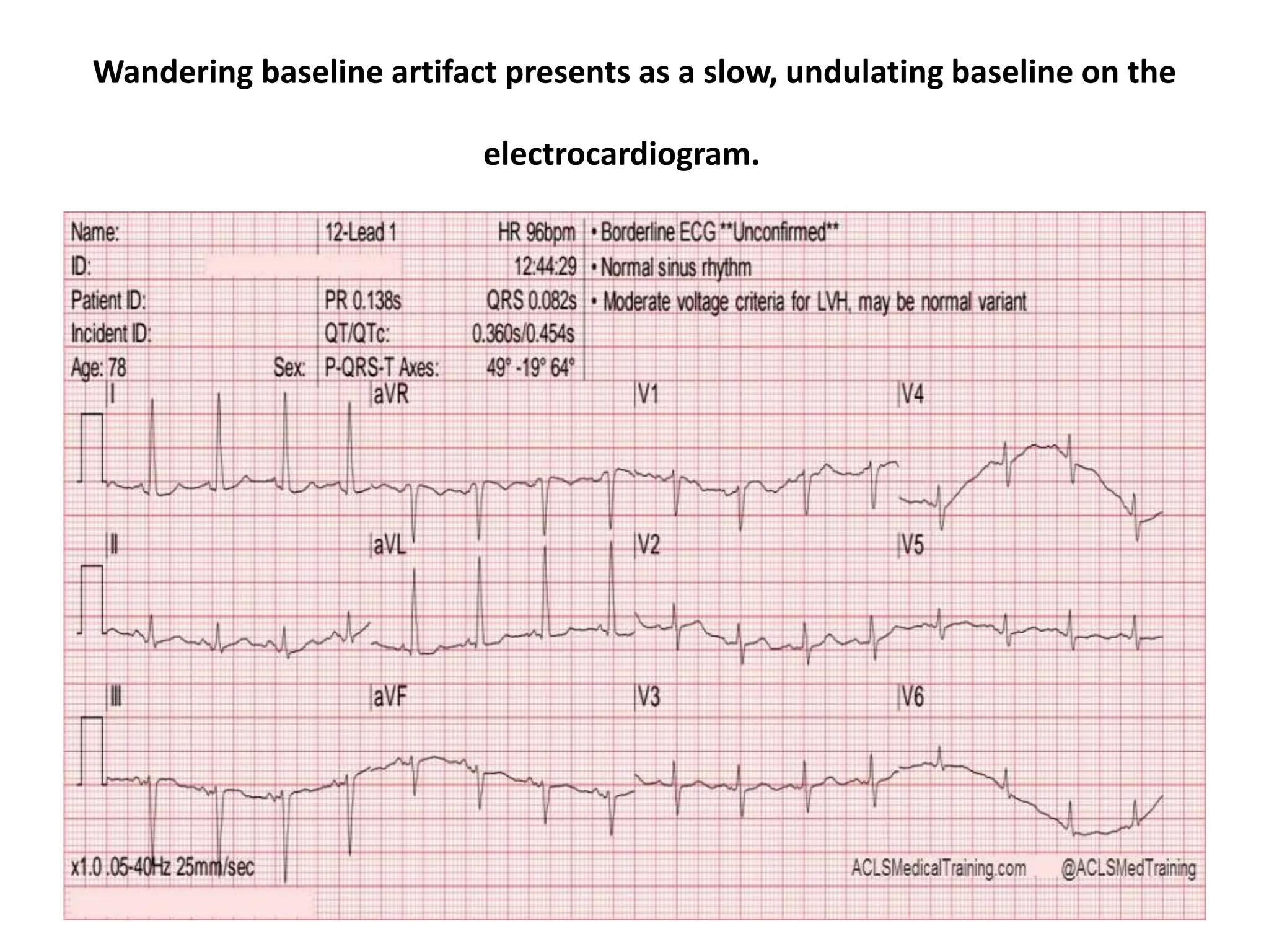 ARTIFACTS IN ECG.pptx
