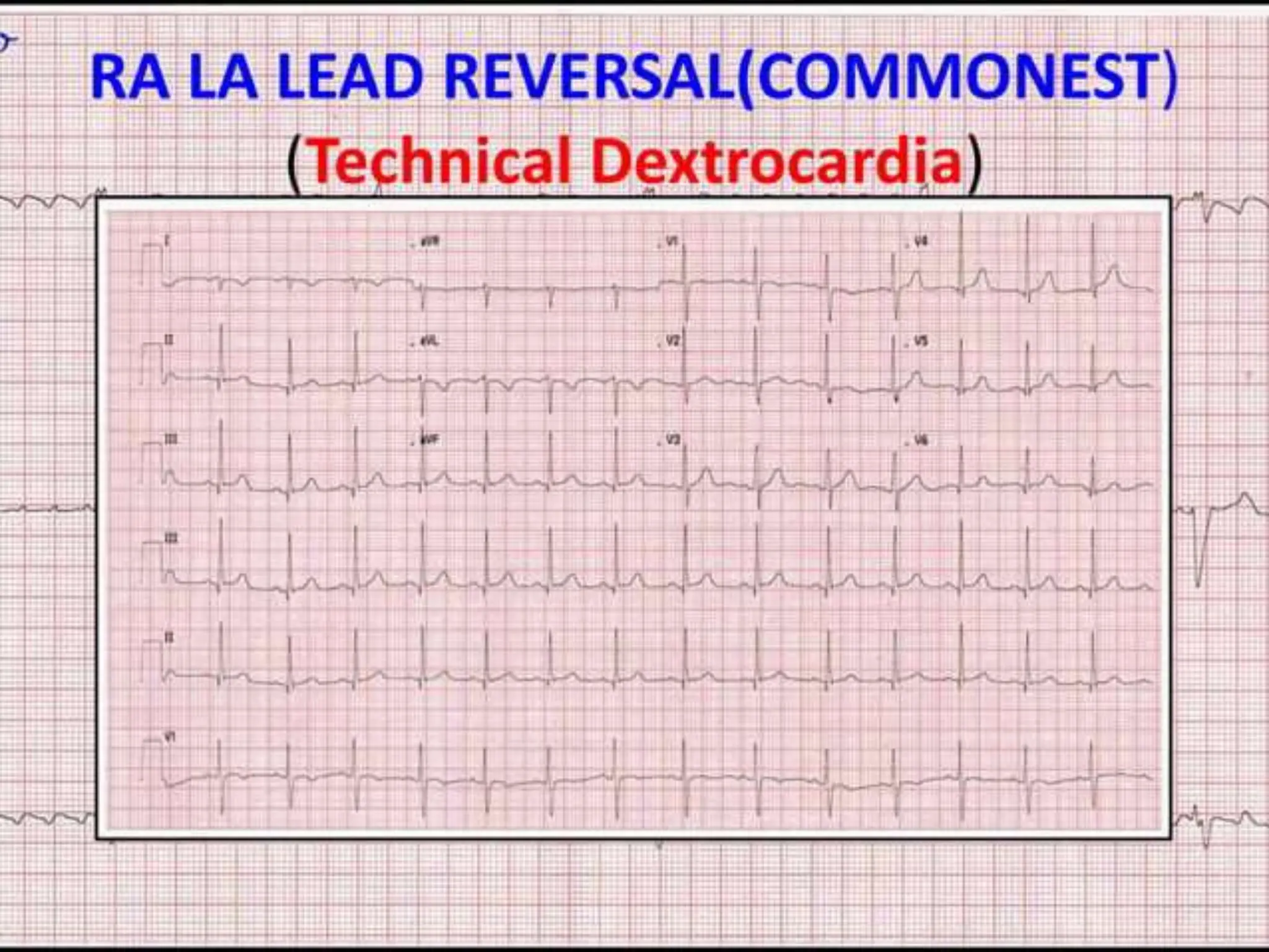 Artifacts In Ecg Pptx Heart And Cardiovascular Diseases Diseases And Conditions