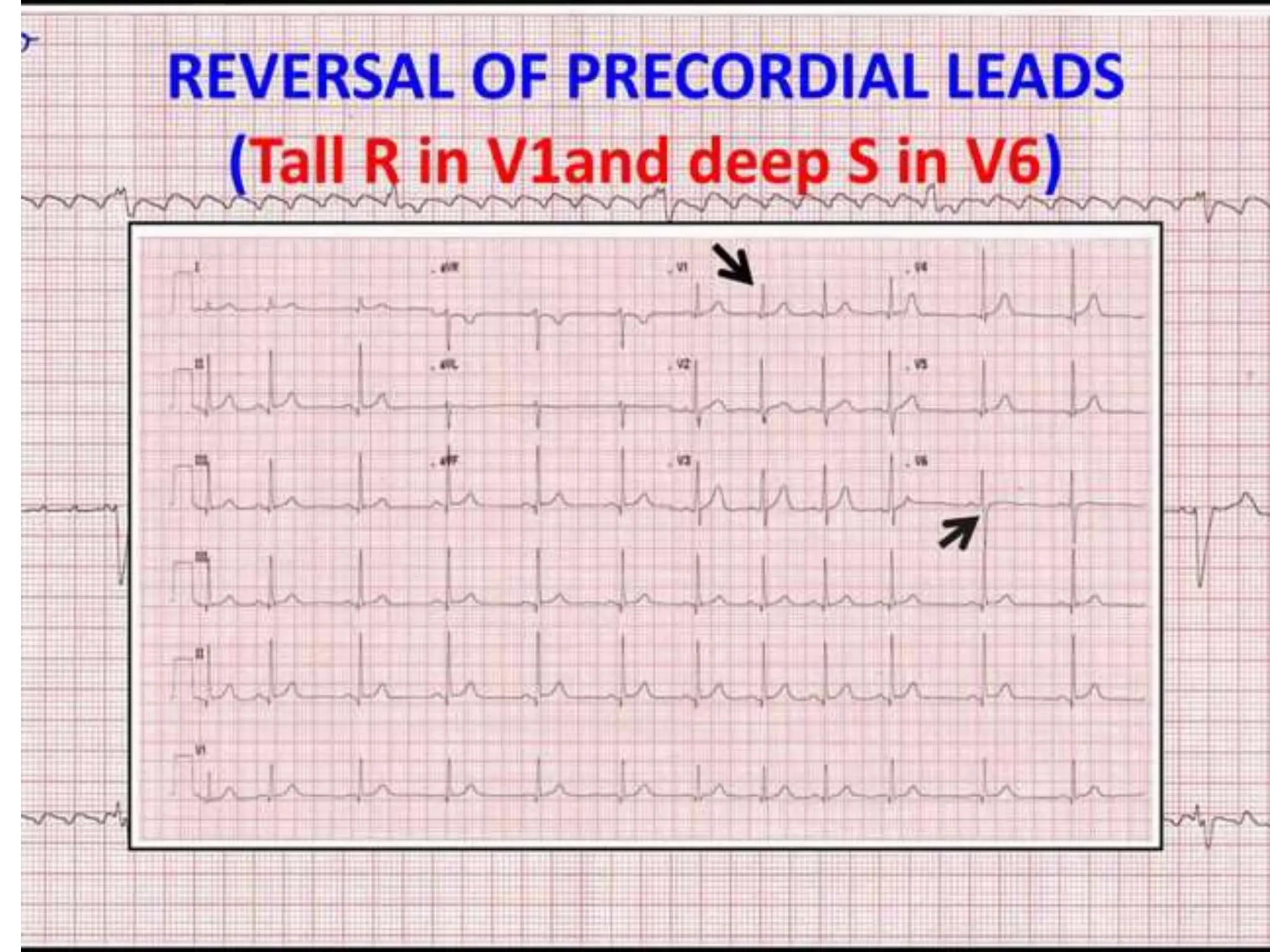 ARTIFACTS IN ECG.pptx