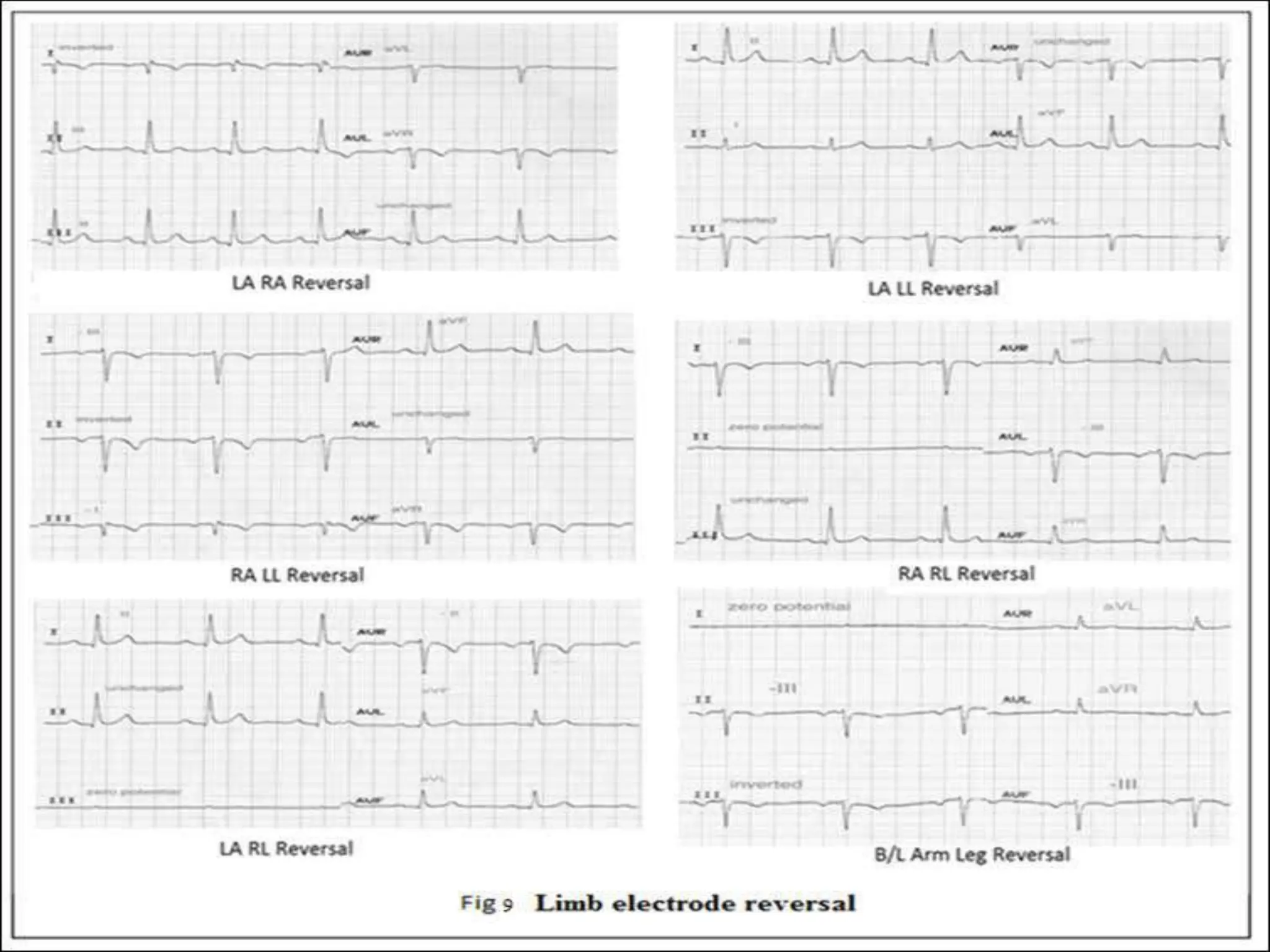 ARTIFACTS IN ECG.pptx