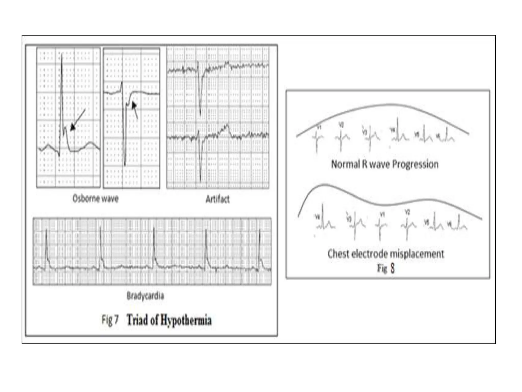 ARTIFACTS IN ECG.pptx