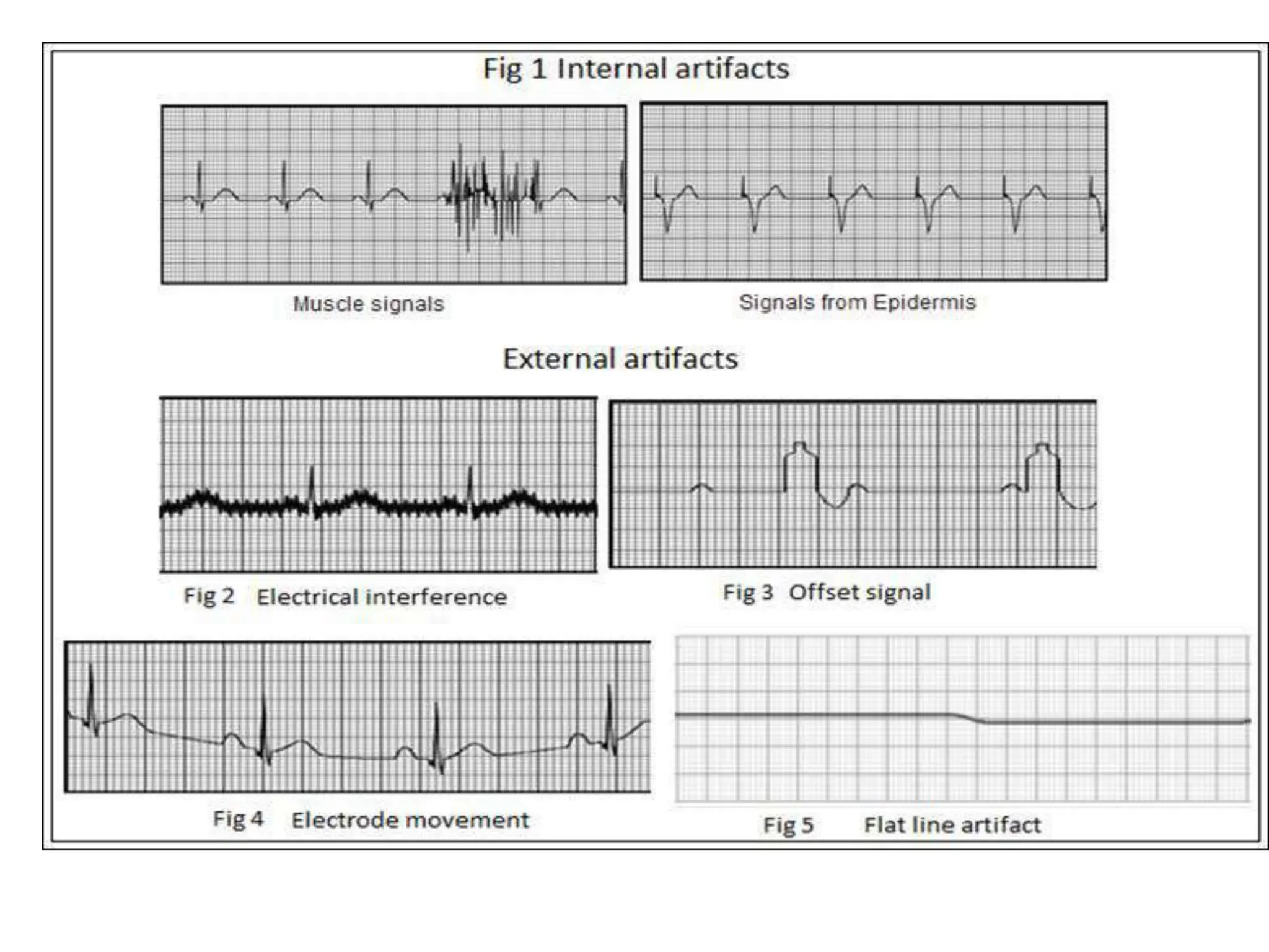 Artifacts In Ecg Pptx Heart And Cardiovascular Diseases Diseases And Conditions