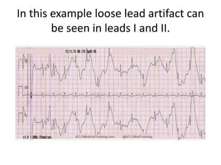 ARTIFACTS IN ECG.pptx