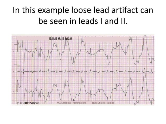 ARTIFACTS IN ECG.pptx | Heart and Cardiovascular Diseases | Diseases ...