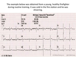 ARTIFACTS IN ECG.pptx