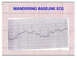 ARTIFACTS IN ECG.pptx