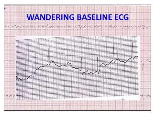 Artifacts In Ecg Pptx Heart And Cardiovascular Diseases Diseases And Conditions