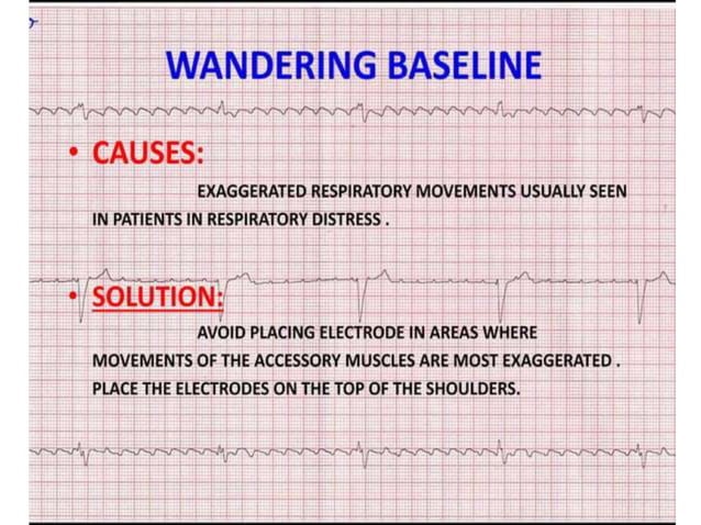 Artifacts In Ecg Pptx Heart And Cardiovascular Diseases Diseases And Conditions