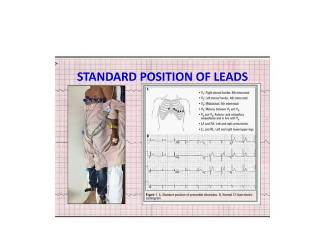 ARTIFACTS IN ECG.pptx | Heart and Cardiovascular Diseases | Diseases and Conditions