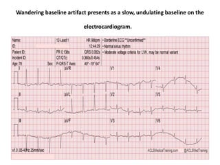 ARTIFACTS IN ECG.pptx