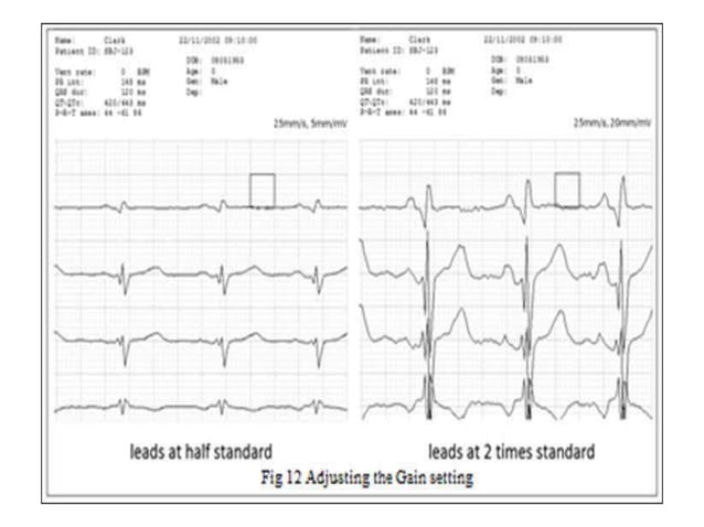 ARTIFACTS IN ECG.pptx | Heart and Cardiovascular Diseases | Diseases and Conditions