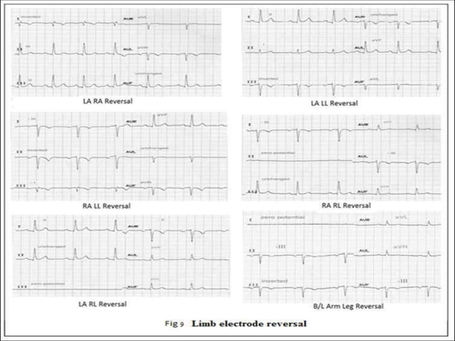 ARTIFACTS IN ECG.pptx | Heart and Cardiovascular Diseases | Diseases and Conditions