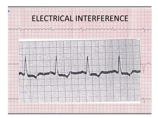 ARTIFACTS IN ECG.pptx