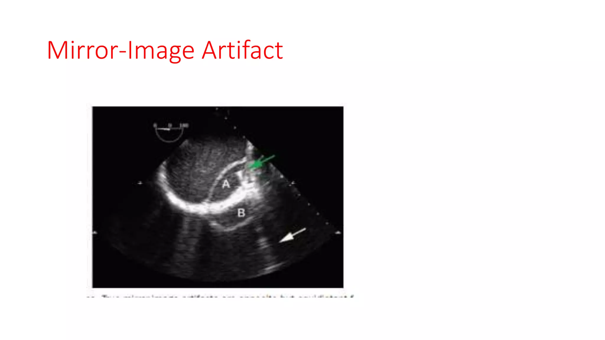 ARTIFACTS IN ECHO-1.pptx