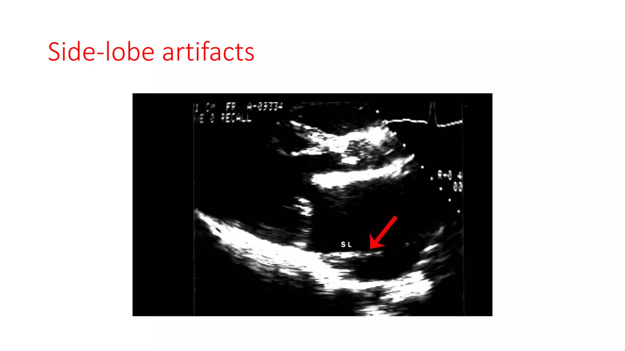ARTIFACTS IN ECHO-1.pptx