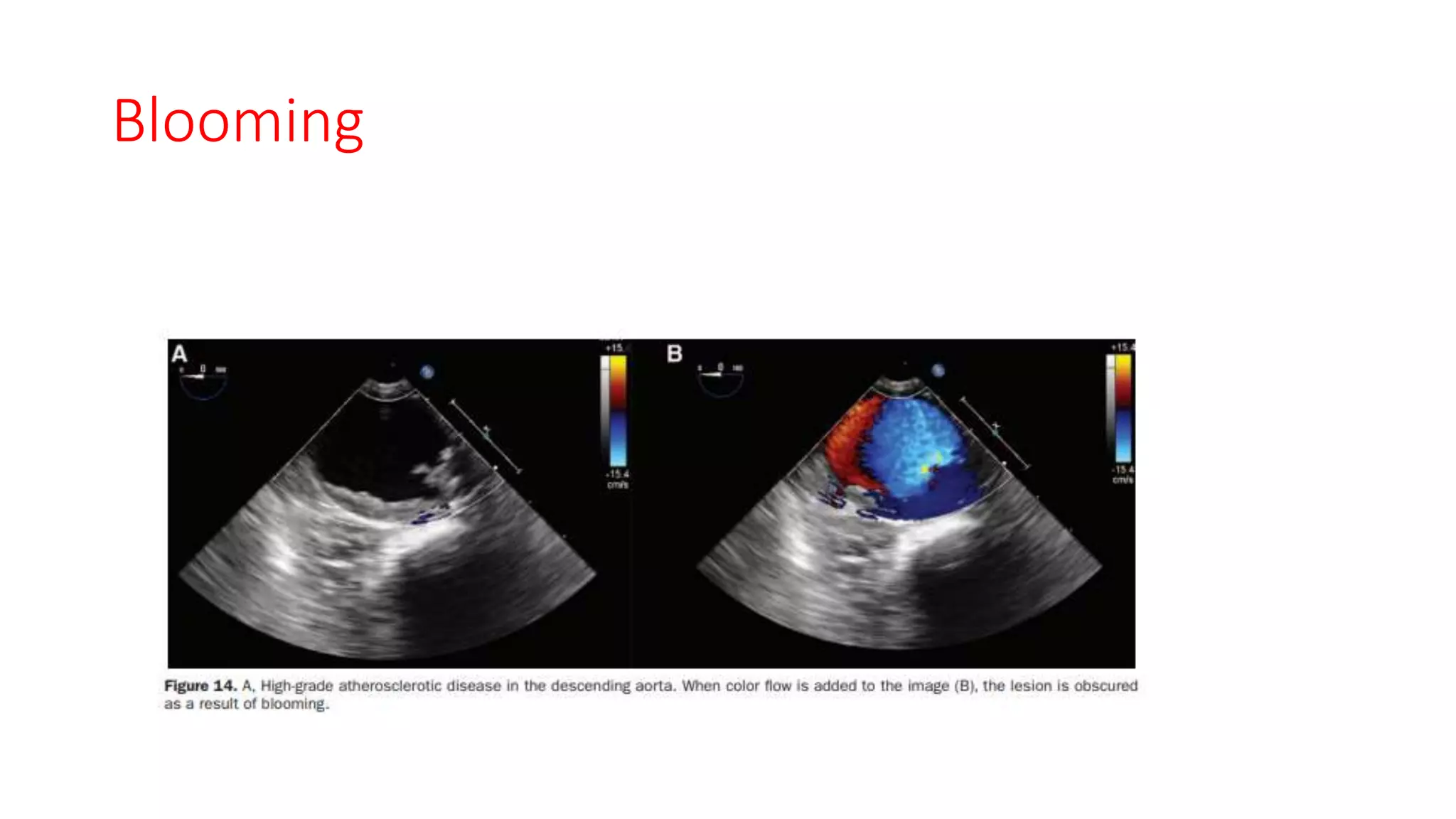 ARTIFACTS IN ECHO-1.pptx