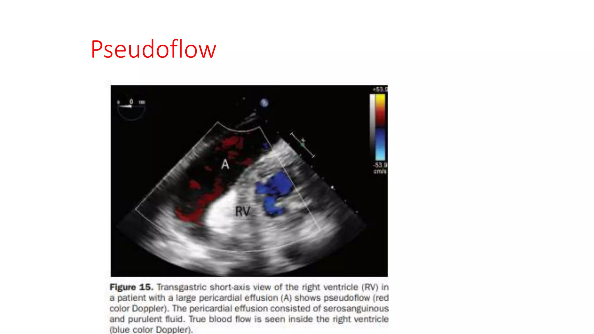 ARTIFACTS IN ECHO-1.pptx