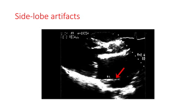 ARTIFACTS IN ECHO-1.pptx