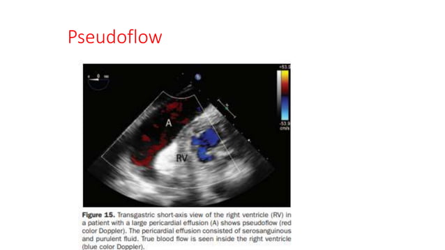 ARTIFACTS IN ECHO-1.pptx