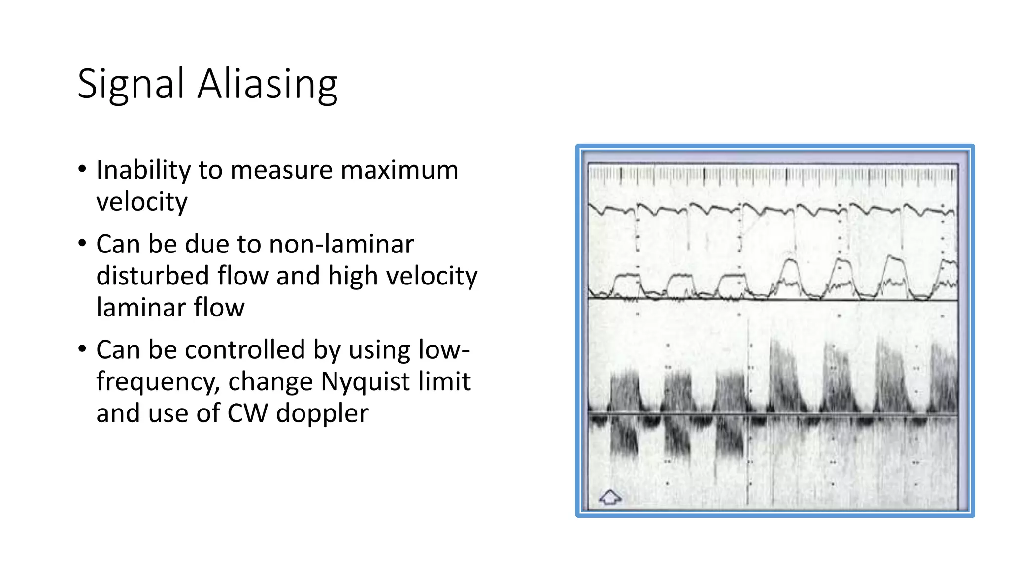 Artifacts in echocardiography | PPTX