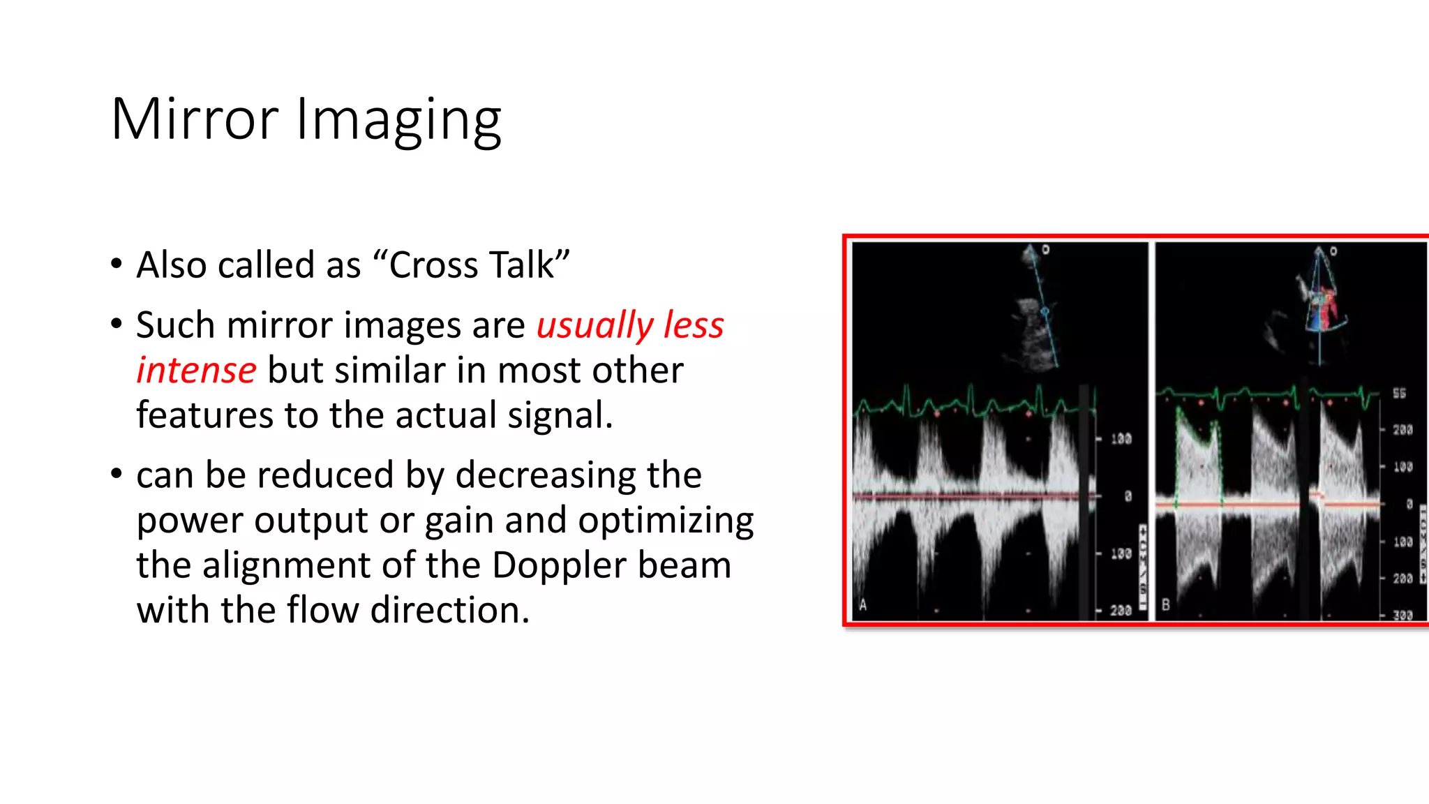 Artifacts in echocardiography | PPTX