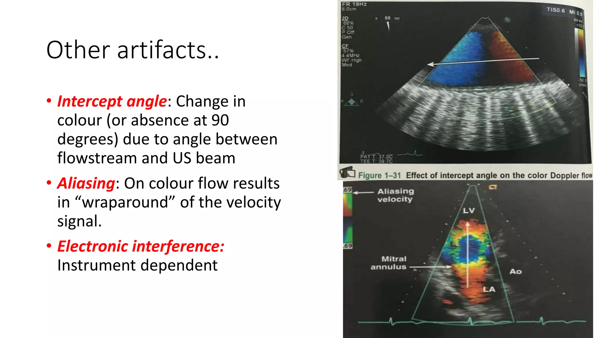 Artifacts in echocardiography | PPTX