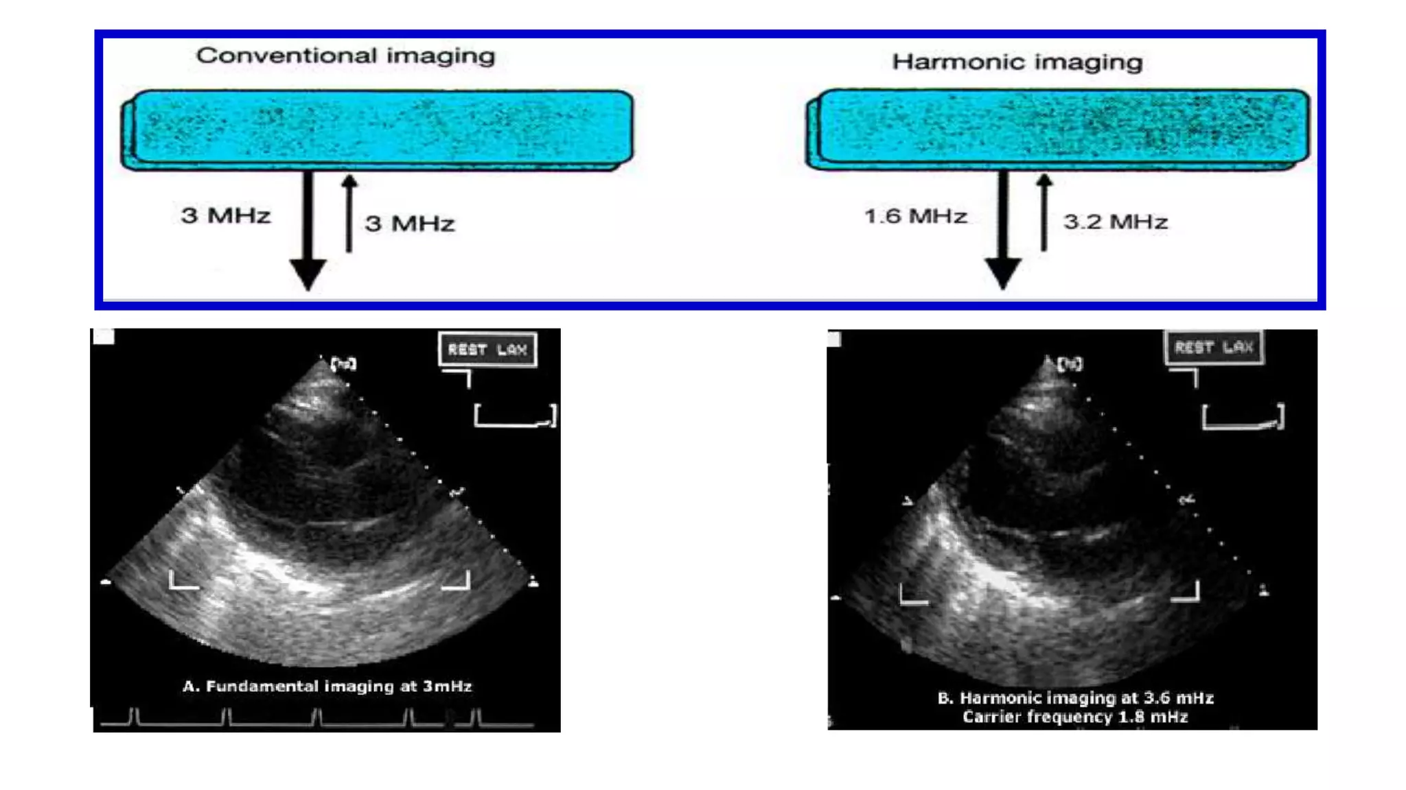 Artifacts in echocardiography | PPTX