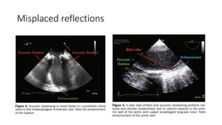 Echocardiography Artifact Clipart