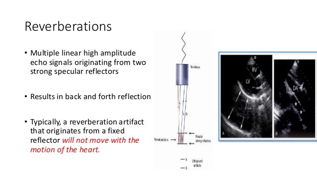 Artifacts in echocardiography