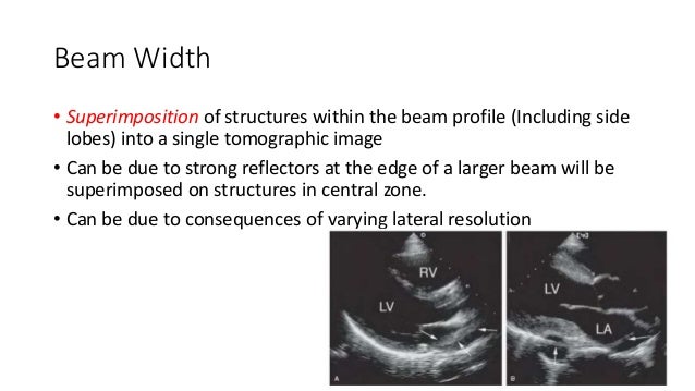 Artifacts in echocardiography