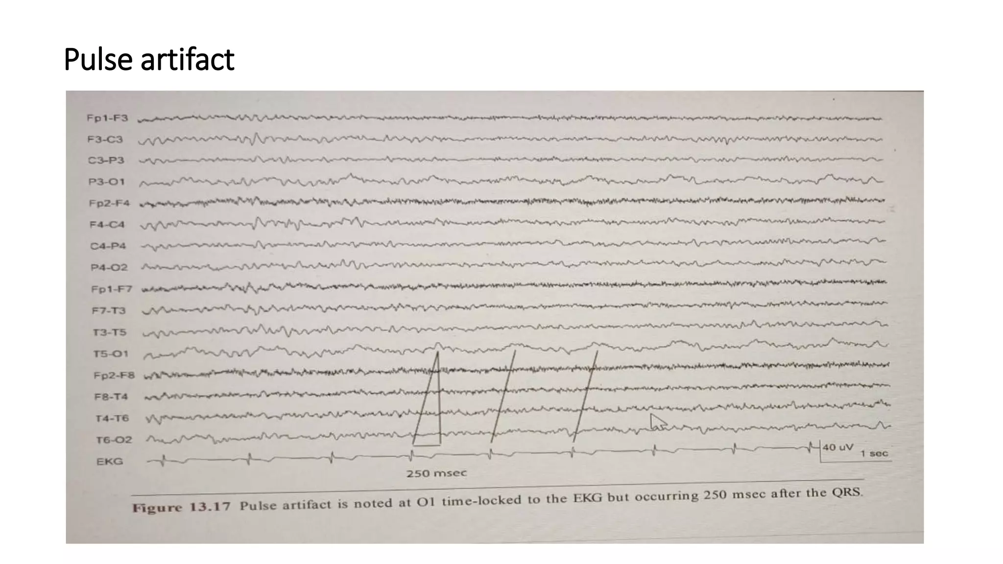 ARTIFACTS IN EEG.pptx