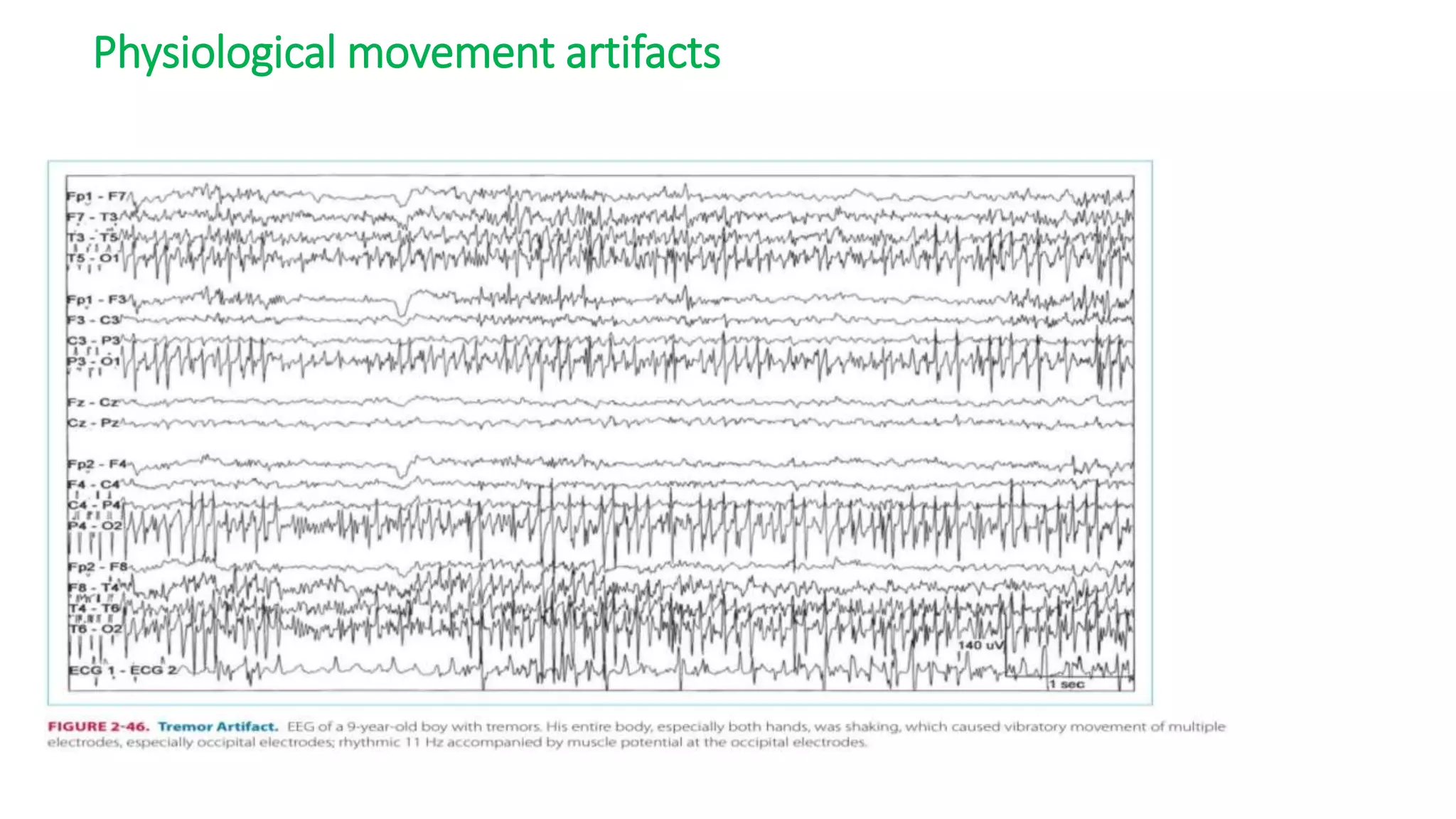 ARTIFACTS IN EEG.pptx