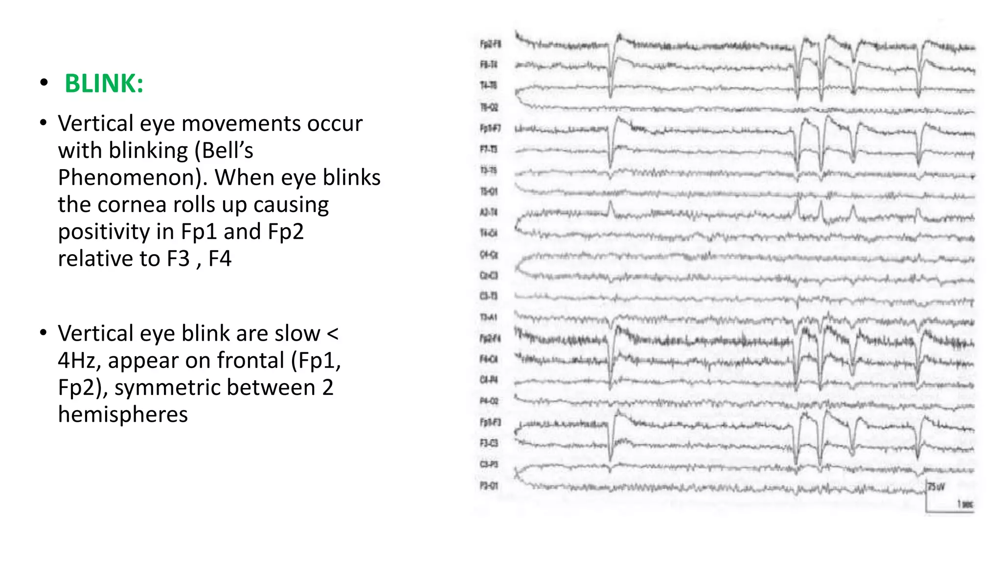 ARTIFACTS IN EEG.pptx